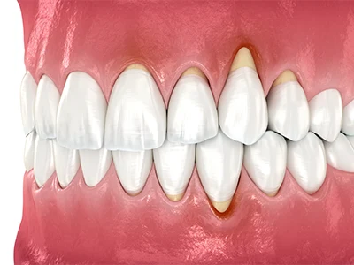How to Get Gums to Stop Bleeding | Dentist Guide